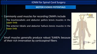 IONM for Spinal Cord Surgery | PPT
