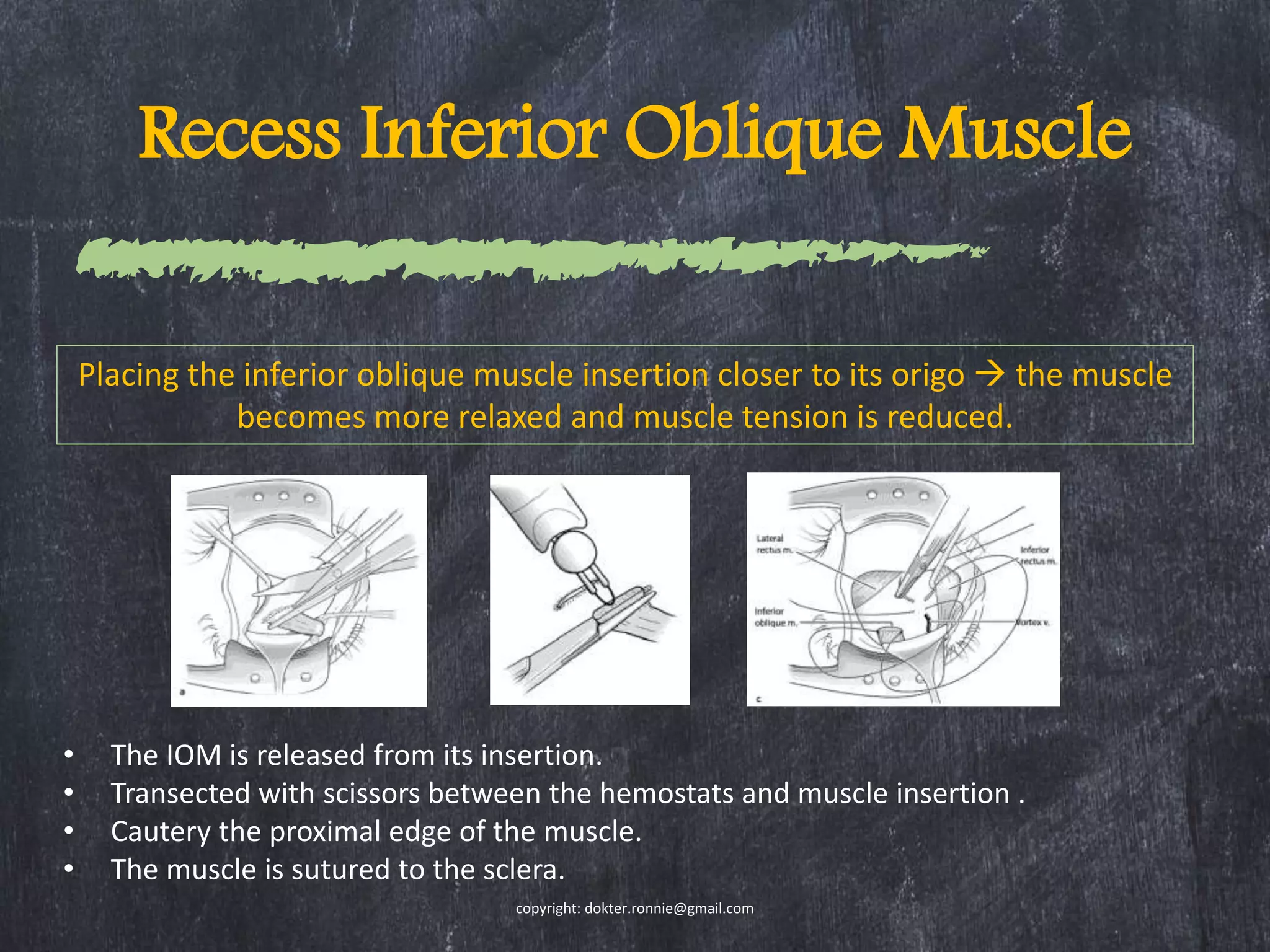 Inferior Oblique Overaction (IOOA) | PPTX