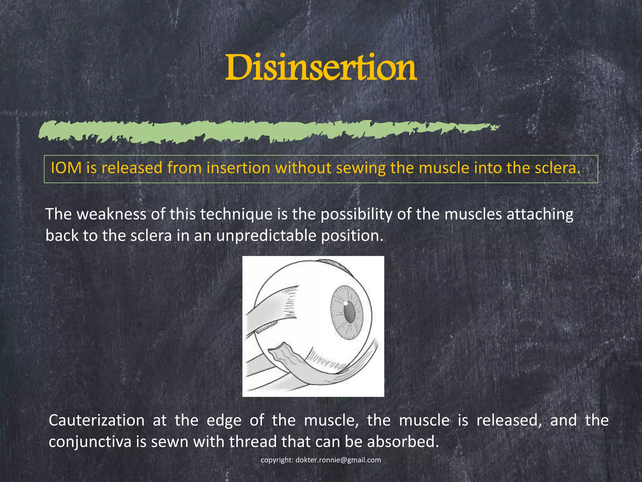 Inferior Oblique Overaction (IOOA) | PPTX