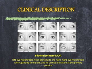 Inferior Oblique Overaction (IOOA) | PPTX