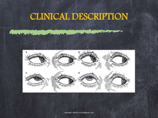 Inferior Oblique Overaction (IOOA) | PPTX