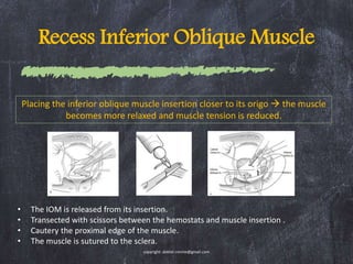 Inferior Oblique Overaction (IOOA) | PPTX