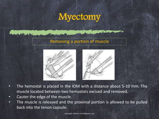Inferior Oblique Overaction (IOOA) | PPTX