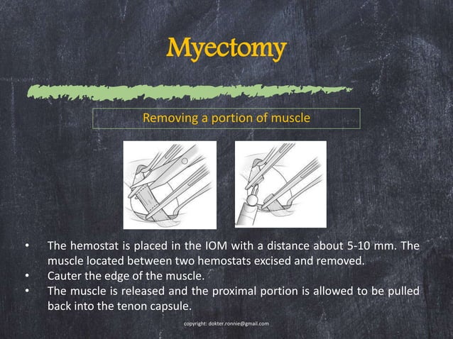 Inferior Oblique Overaction (IOOA) | PPTX | Eye and Vision Conditions ...