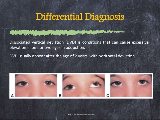 Inferior Oblique Overaction (IOOA)
