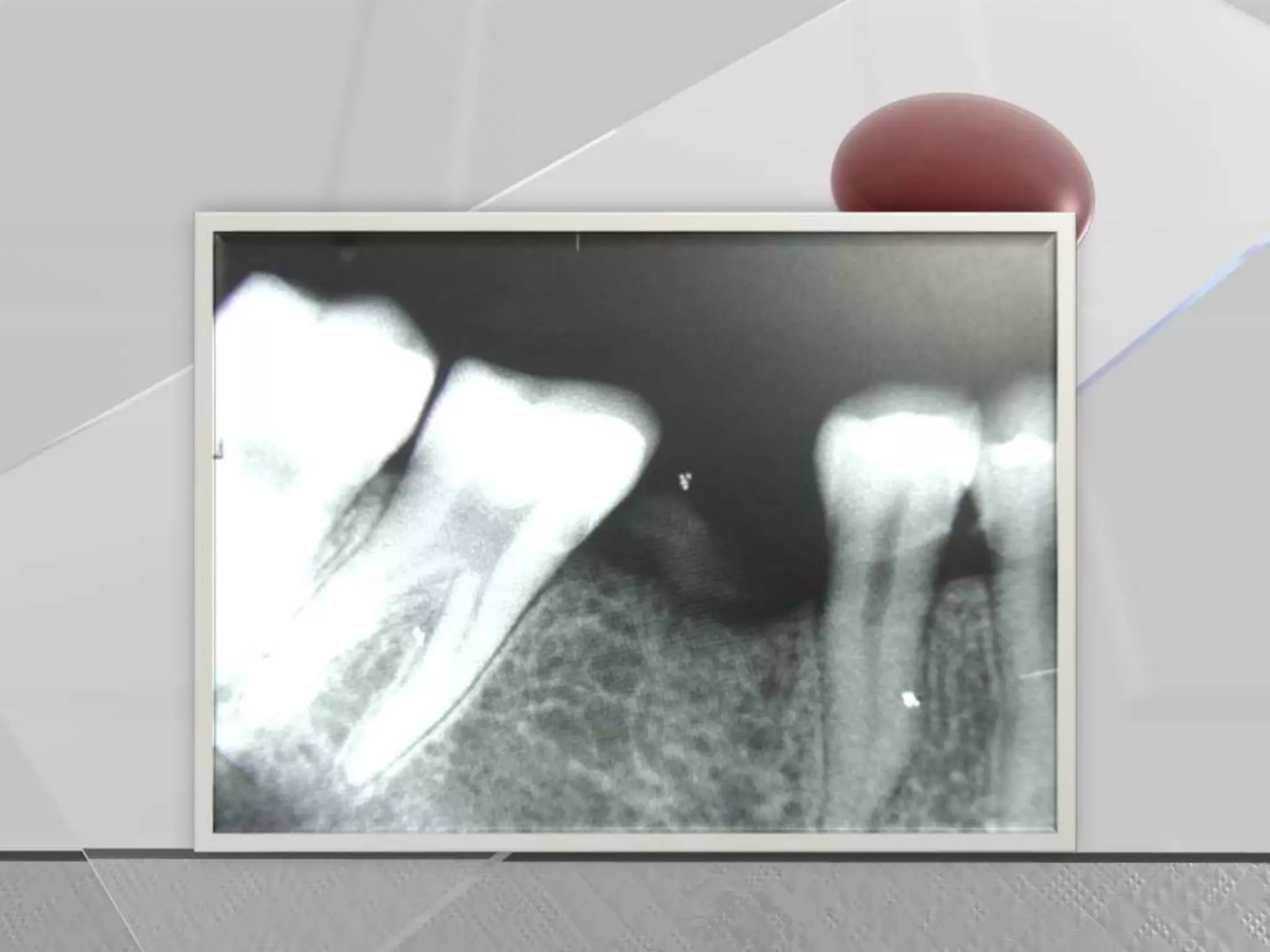 IOPA INTERPRETATION.ppt