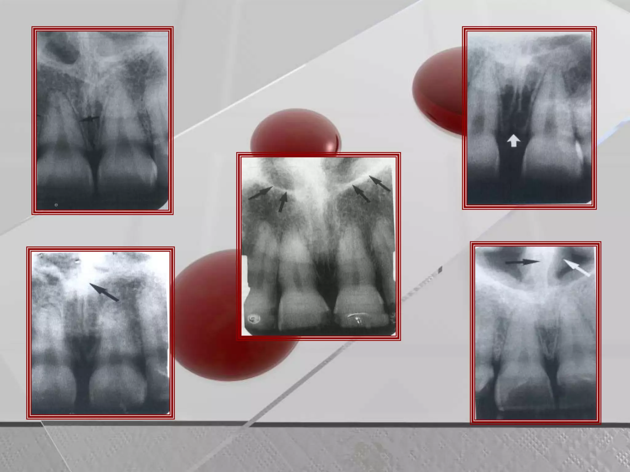 IOPA INTERPRETATION.ppt