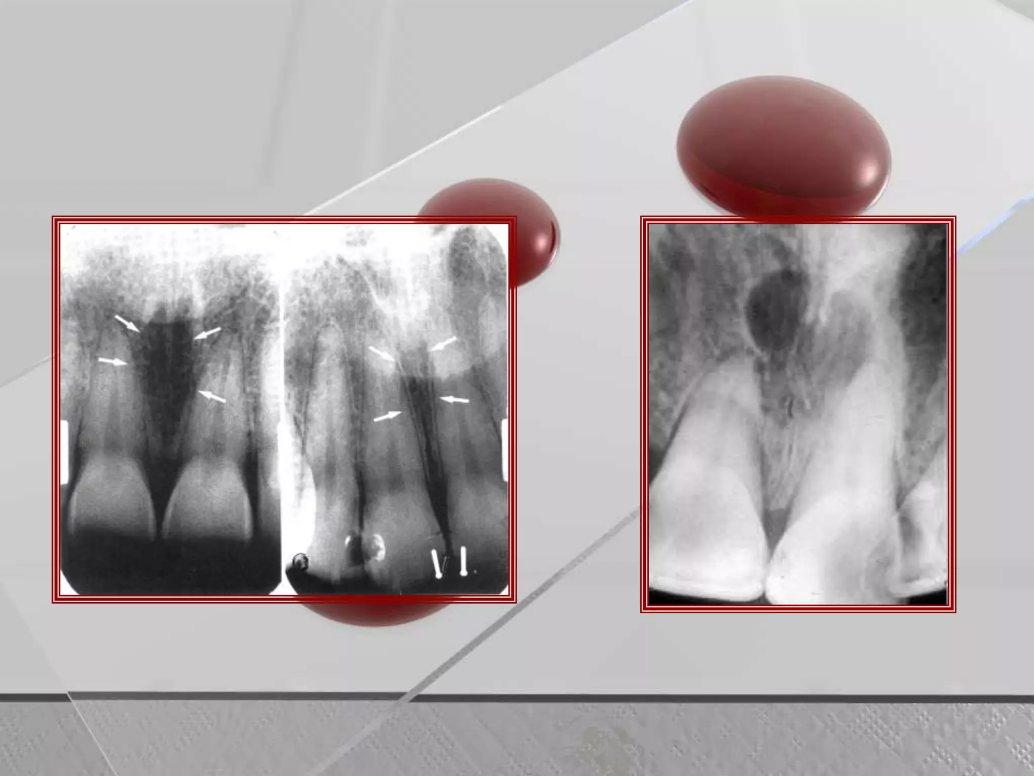 IOPA INTERPRETATION.ppt