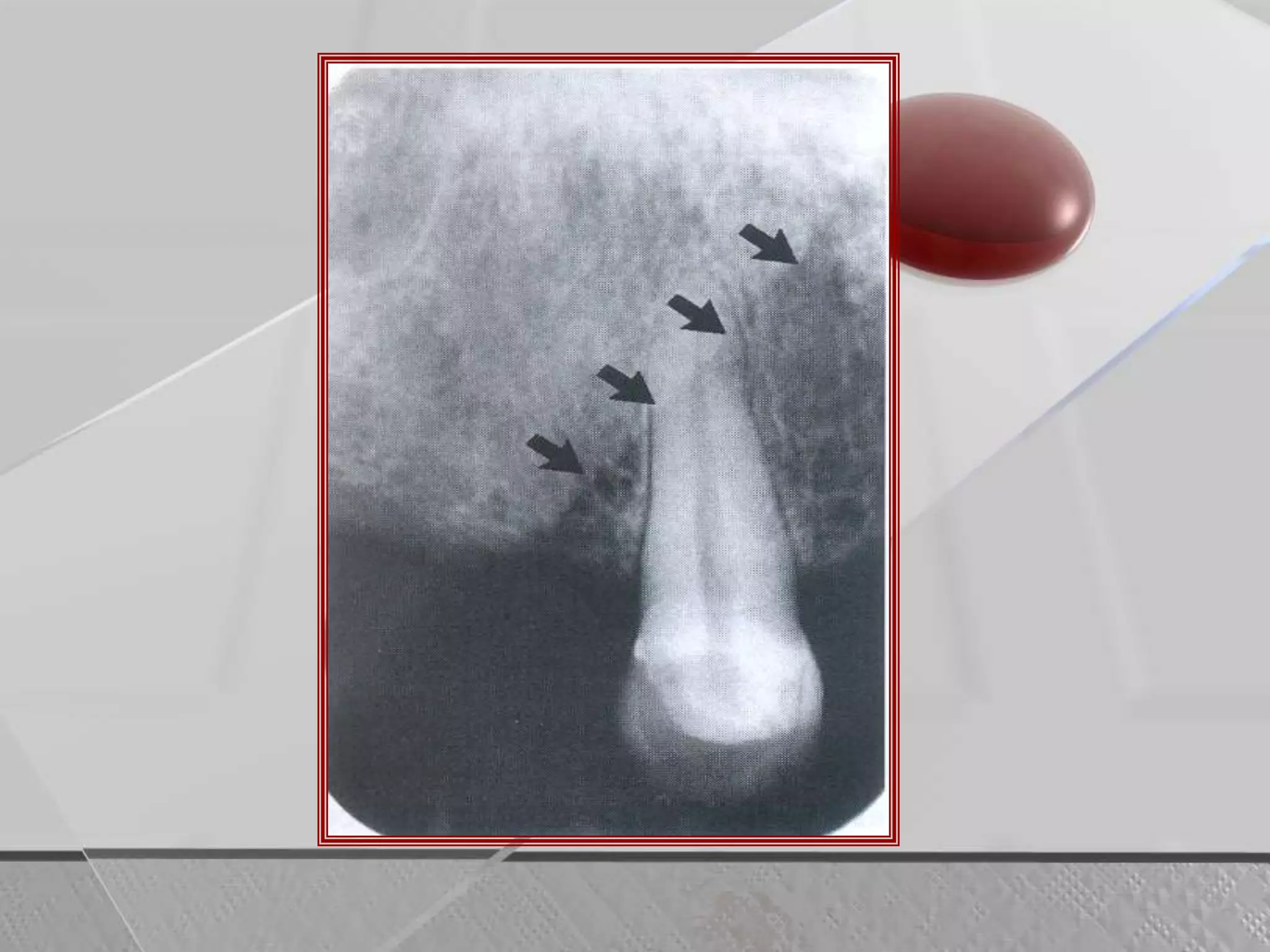 IOPA INTERPRETATION.ppt