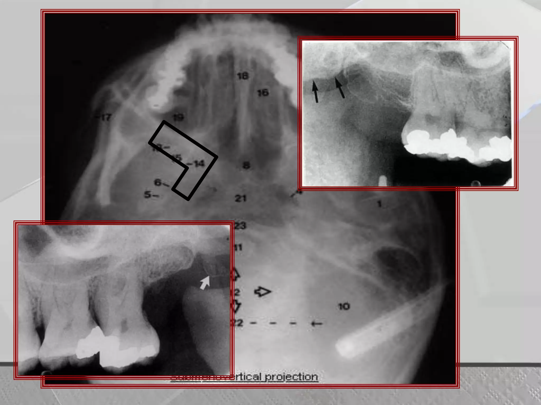 IOPA INTERPRETATION.ppt