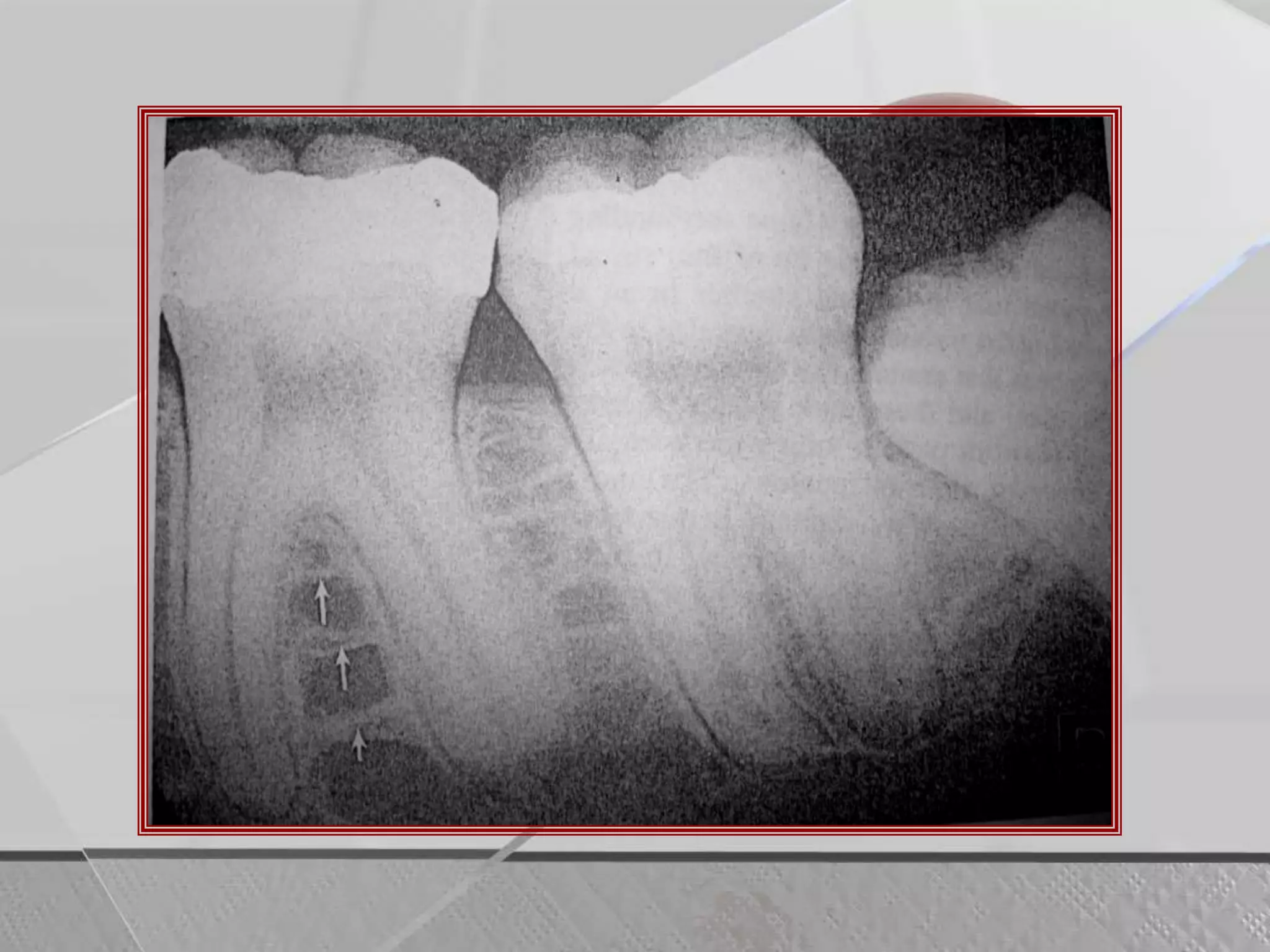 IOPA INTERPRETATION.ppt