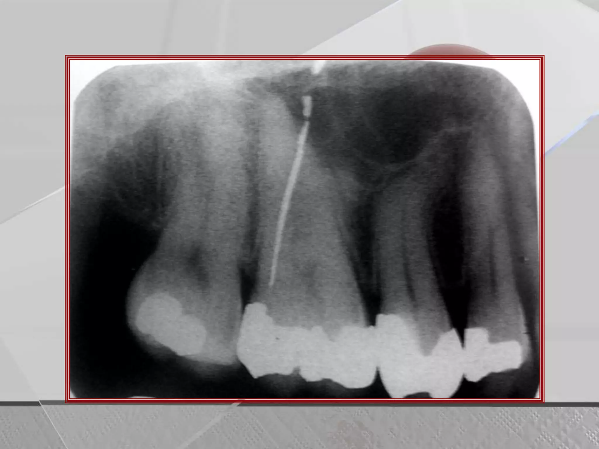 IOPA INTERPRETATION.ppt