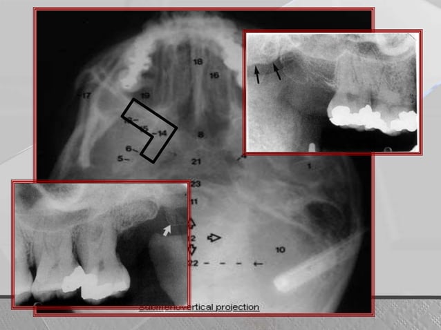 IOPA INTERPRETATION.ppt