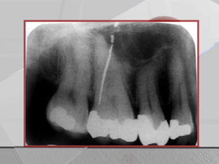 IOPA INTERPRETATION.ppt