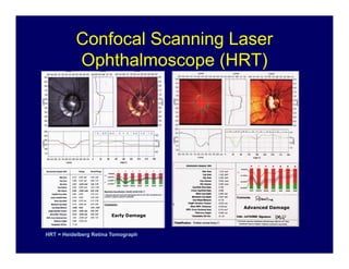 Iop compliance and fluctuations | PPT