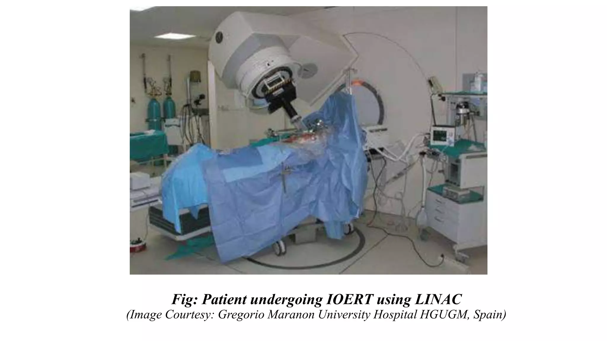 Intraoperative Radiotherapy (IORT) | PPTX