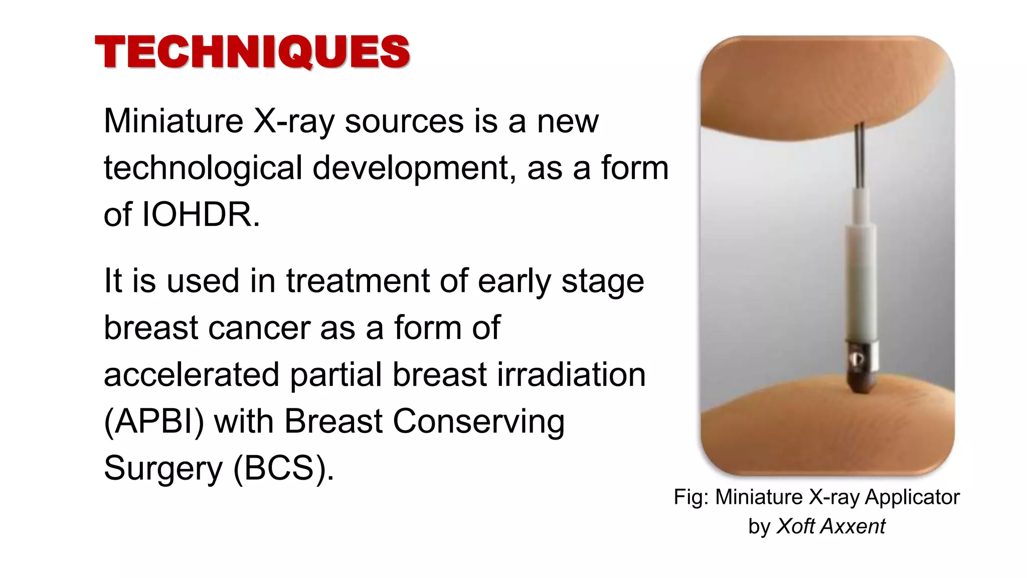 Intraoperative Radiotherapy (IORT) | PPTX
