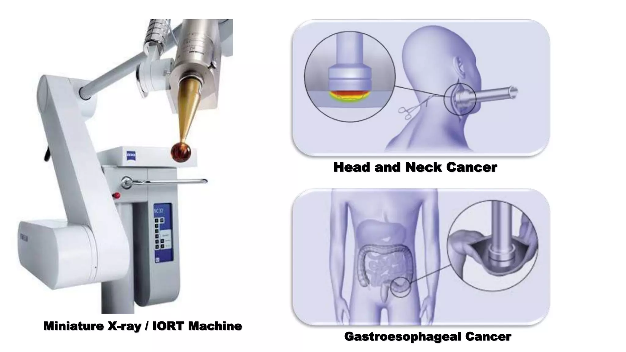 Intraoperative Radiotherapy (IORT) | PPTX