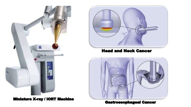 Intraoperative Radiotherapy (IORT)