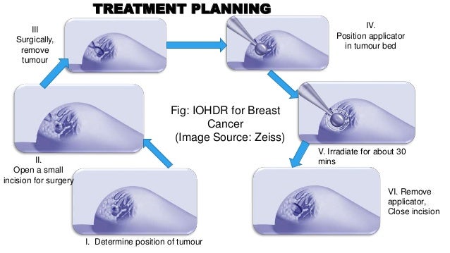 Intraoperative Radiotherapy (IORT)