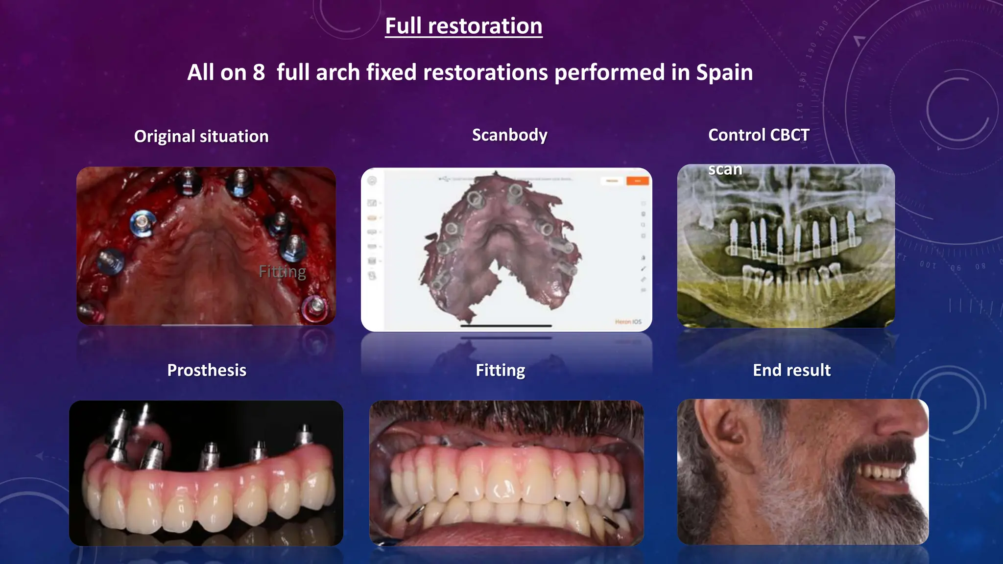 Presentation on Basics of Intra Oral Scanner | PPTX
