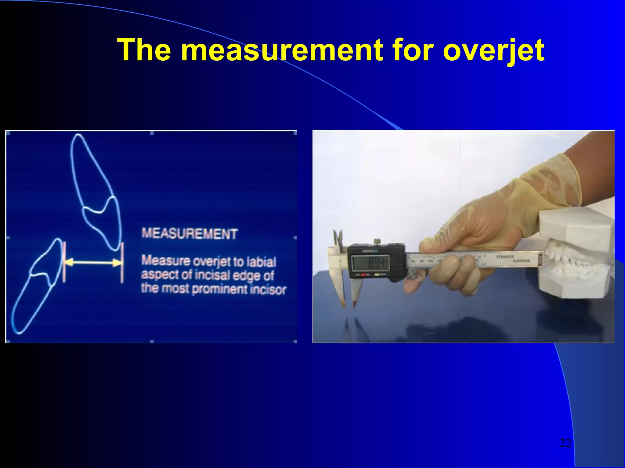 Index of Orthodontic Treatment Need (IOTN) | PPT
