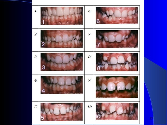 Index of Orthodontic Treatment Need (IOTN) | PPT | Dental Health ...