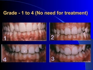 Index of Orthodontic Treatment Need (IOTN) | PPT