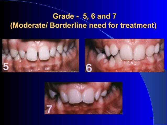 Index of Orthodontic Treatment Need (IOTN) | PPT | Dental Health ...