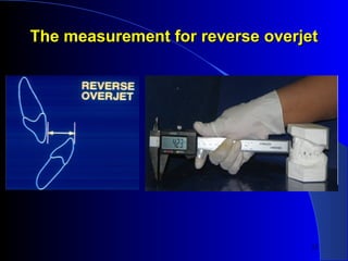 Index of Orthodontic Treatment Need (IOTN) | PPT