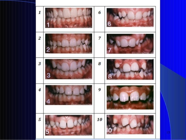 Index of Orthodontic Treatment Need (IOTN)