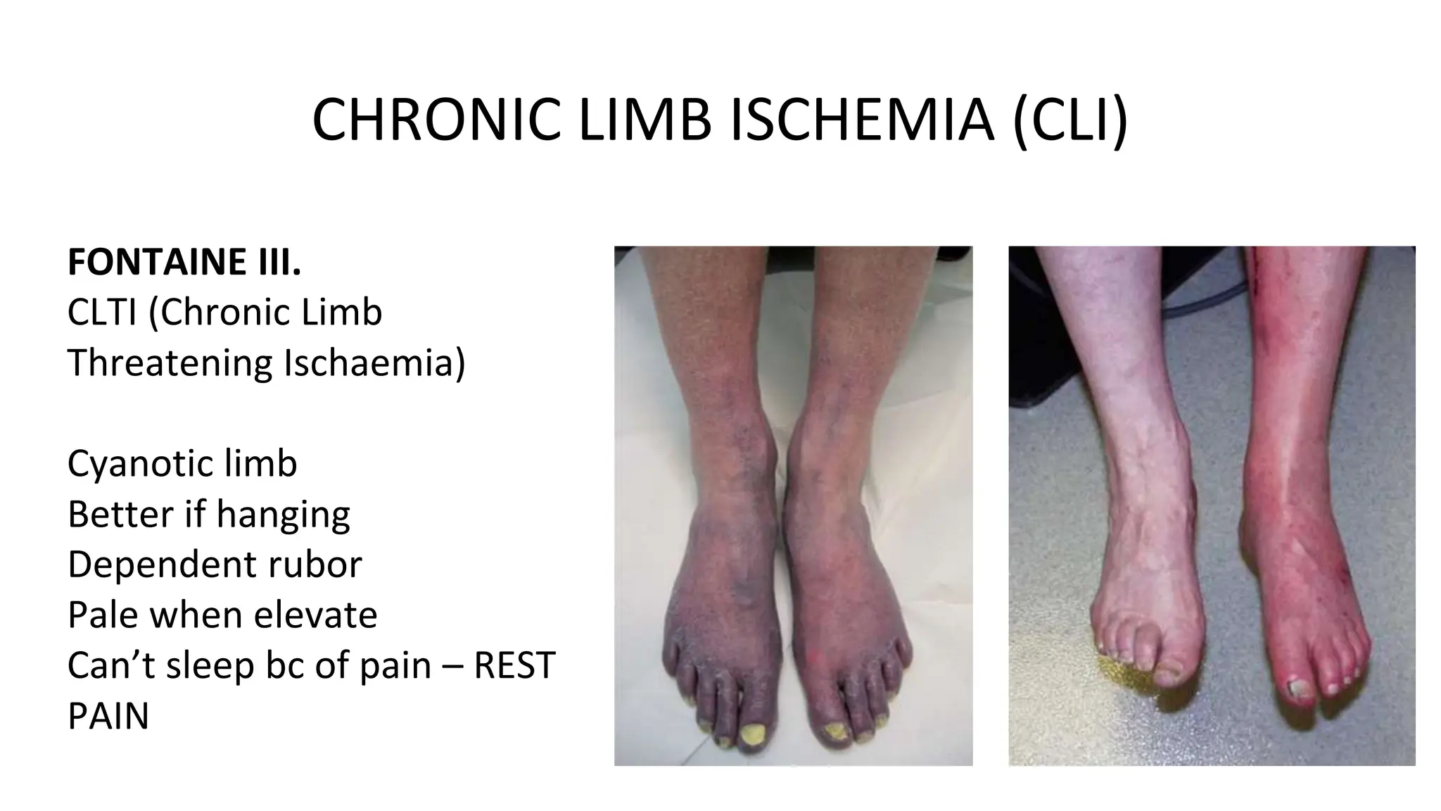 Diagnosis and treatment of lower extremity vascular diseases | PPTX