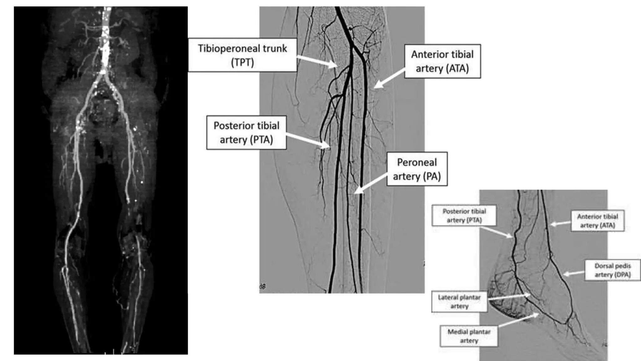 Diagnosis and treatment of lower extremity vascular diseases | PPTX