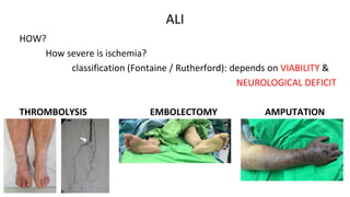 Diagnosis and treatment of lower extremity vascular diseases | PPTX