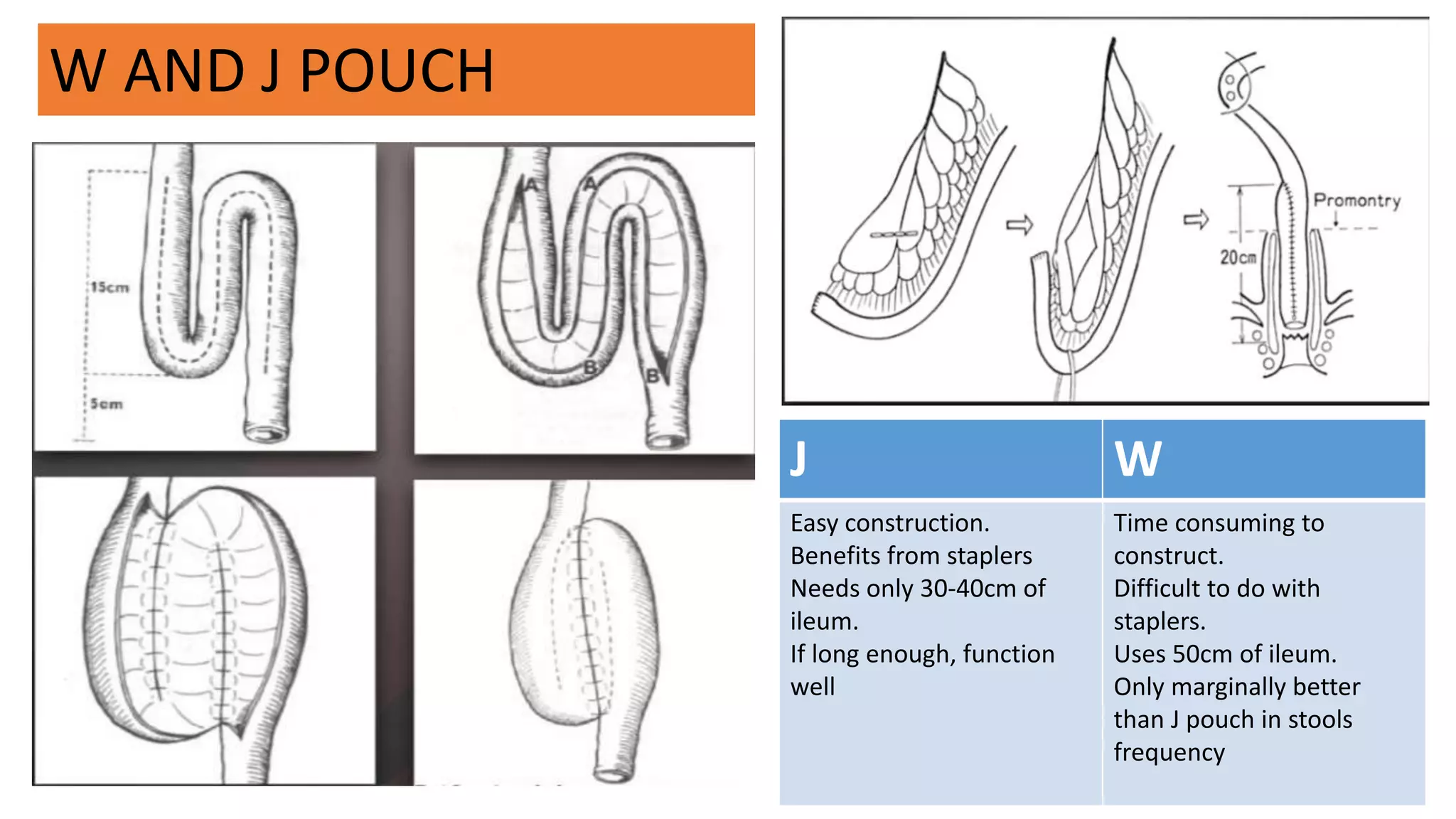 ILEAL POUCH ANAL ANASTOMOSIS | PPTX