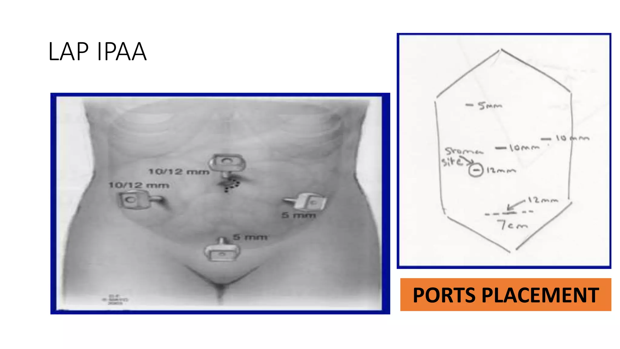 ILEAL POUCH ANAL ANASTOMOSIS | PPTX