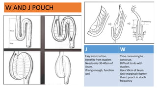 ILEAL POUCH ANAL ANASTOMOSIS | PPTX