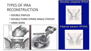 ILEAL POUCH ANAL ANASTOMOSIS | PPTX