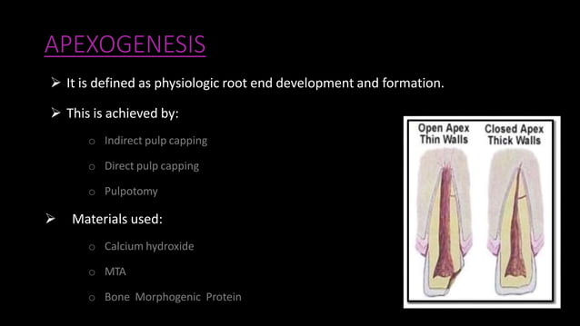 IPC,DPC, APEXIFICATION & APEXOGENESIS WITH RECENT TECHNIQUES ...