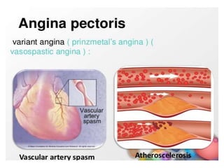 angina pectoris | PPT