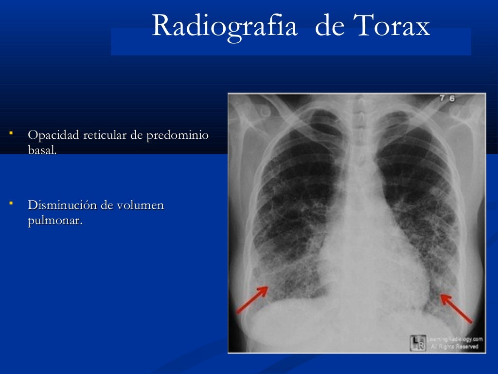 Fibrosis Pulmonar Idiopatica