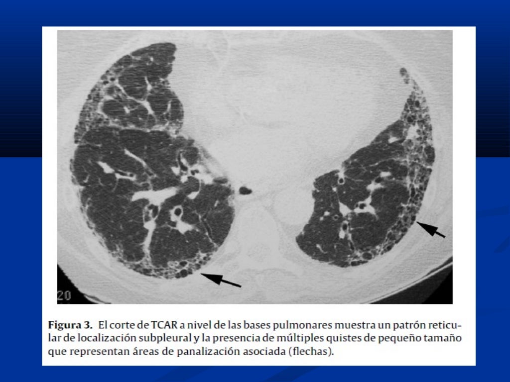 Fibrosis Pulmonar Idiopatica Causas Etapas Sintomas Tratamiento ... Fibrosis Pulmonar Idiopatica Causas Etapas Sintomas Tratamiento ...