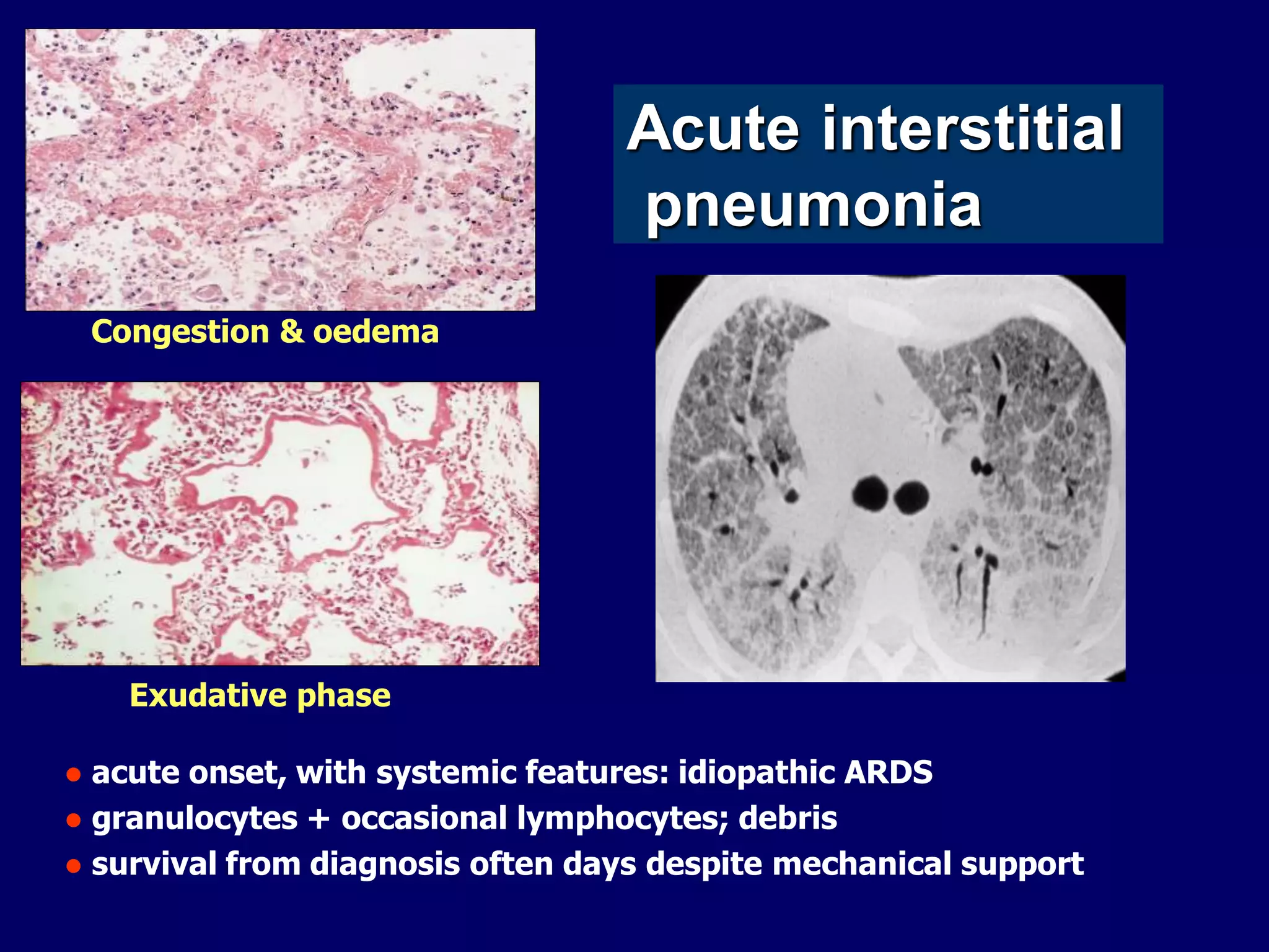 Ipf or non ipf interstitial lung diseases | PDF