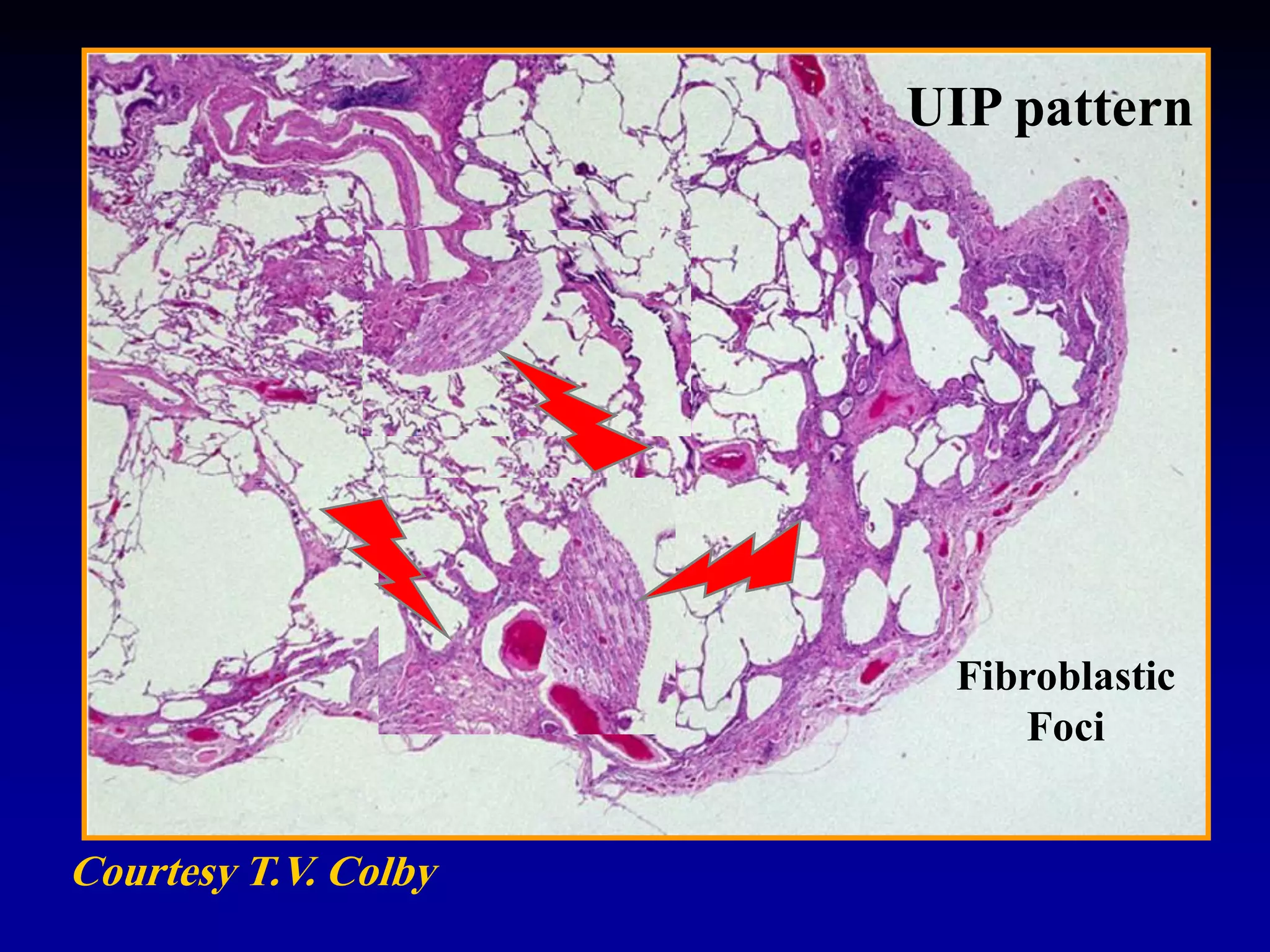 Ipf or non ipf interstitial lung diseases | PDF