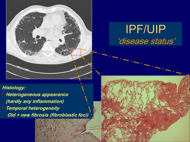 Ipf or non ipf interstitial lung diseases | PDF | Lung and Respiratory ...
