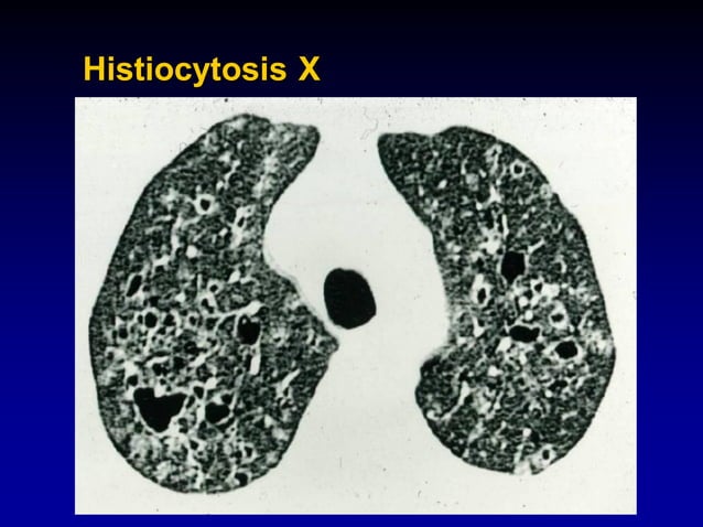 Ipf or non ipf interstitial lung diseases | PDF | Lung and Respiratory ...