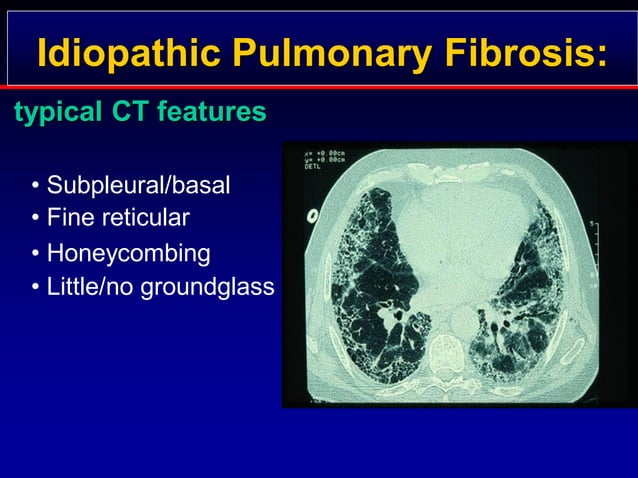 Ipf or non ipf interstitial lung diseases | PDF | Lung and Respiratory ...