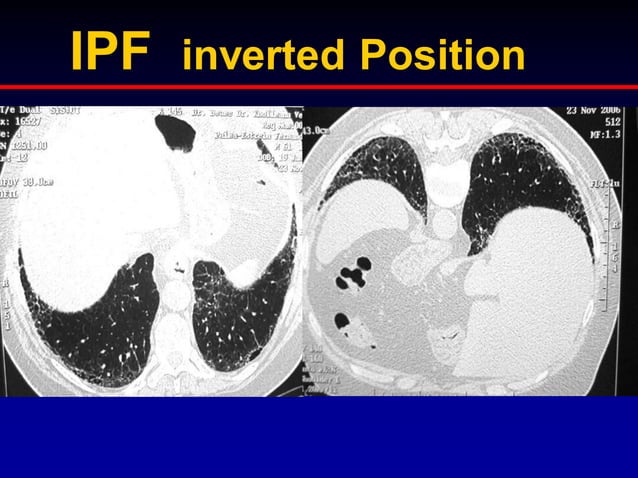 Ipf or non ipf interstitial lung diseases | PDF | Lung and Respiratory ...
