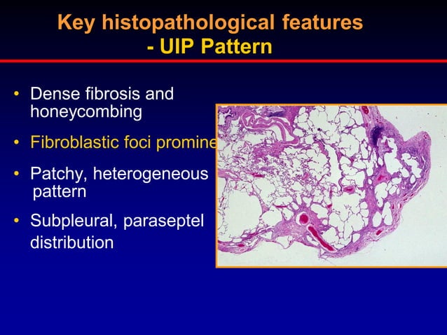 Ipf or non ipf interstitial lung diseases | PDF | Lung and Respiratory ...