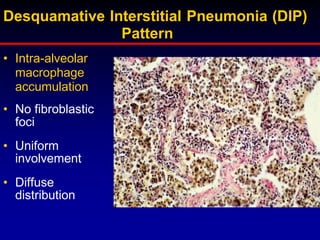 Pneumonia Lung Slide